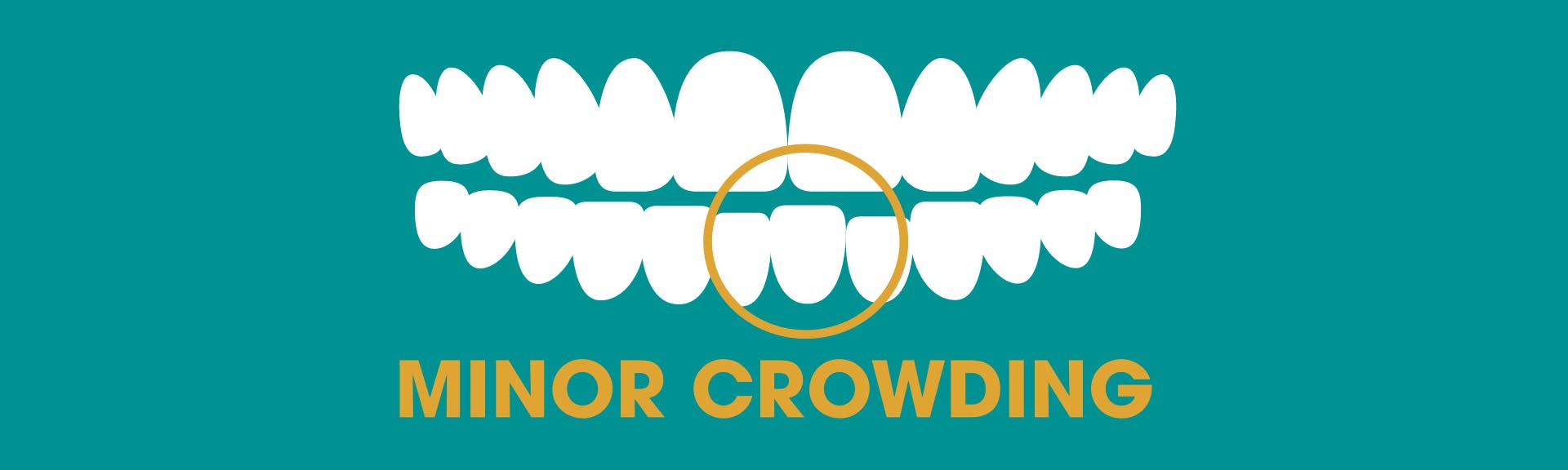 Designing Your Custom Smile with Dental Veneers - The Dentists at Town ...